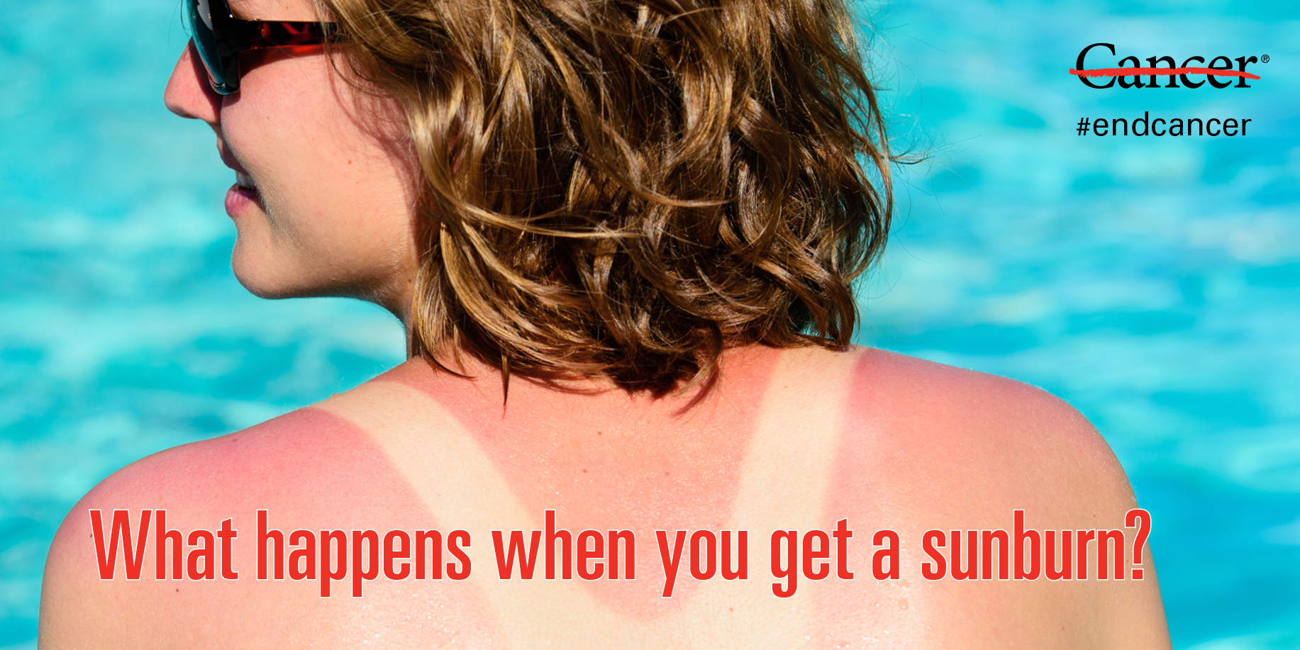 What Happens To Your Skin When You Get A Sunburn MD Anderson Cancer What Happens To Your Skin When You Get A Sunburn MD Anderson Cancer