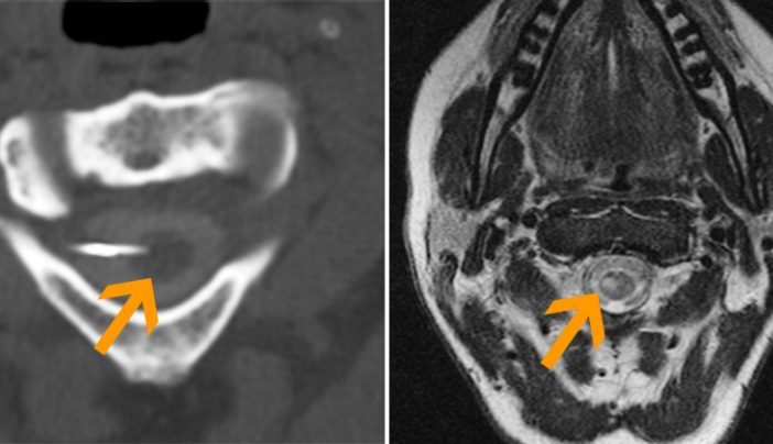 Cordotomía guiada por imágenes para el dolor oncológico | MD Anderson ...
