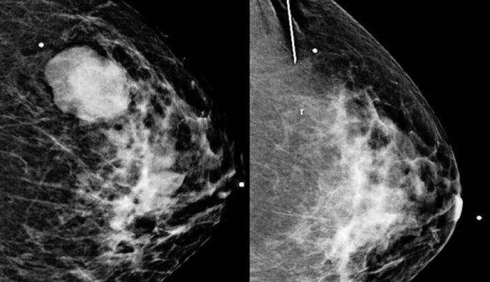Tratamiento para el cáncer de mama sin cirugía | UT MD Anderson